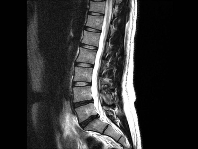 MRI – Lumbar Spine Scan - Dubai-Dr